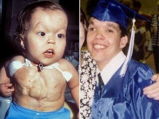 Man Born With Heart Outside Chest Celebrates 34th Birthday