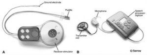 Deaf Toddler Receives Bionic Ear, Weeks Later Speaks Her First Word