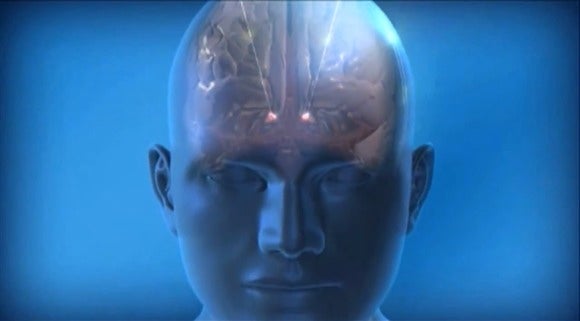 Brain Pacemakers Used To Treat Alzheimer's Disease