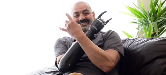 Bebionic Prosthetic Hand Continues To Amaze In Latest Video