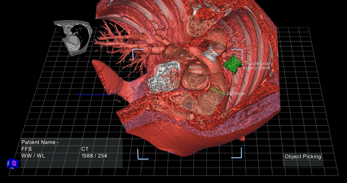 Your Doctor Can Now Examine an Exact 3D Replica of Your Heart in ...