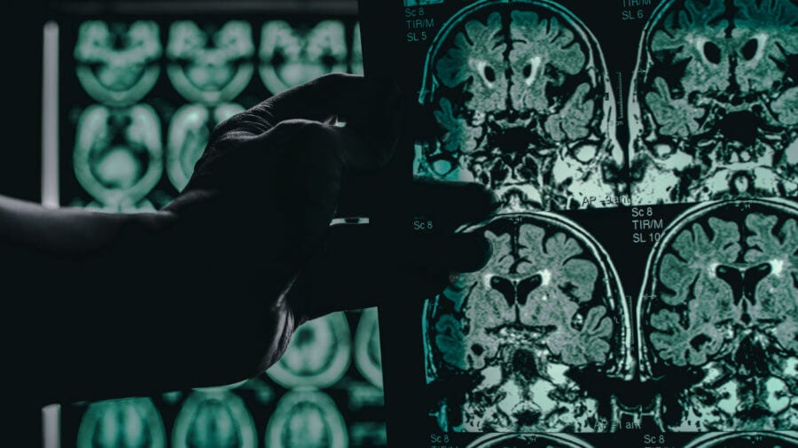 This Memory Prosthesis Boosts Recall in Humans by Roughly 40 Percent