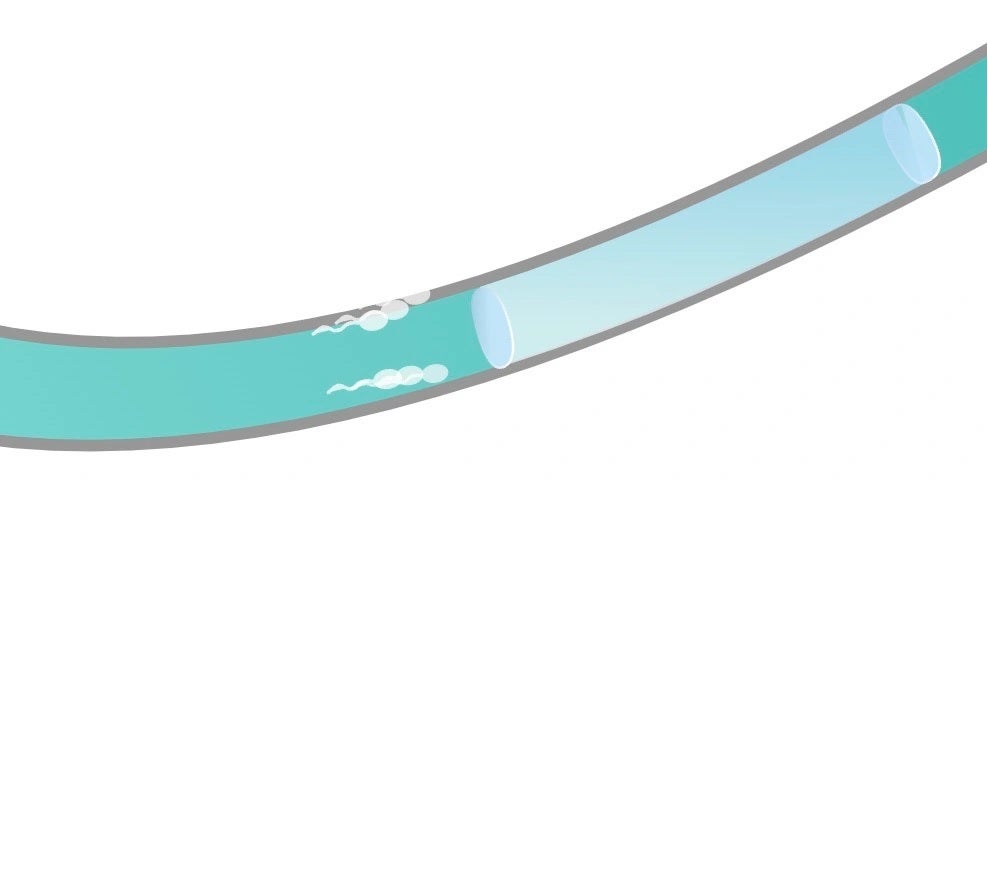 A New Sperm-Blocking Male Birth Control Method Is Being Put to the Test