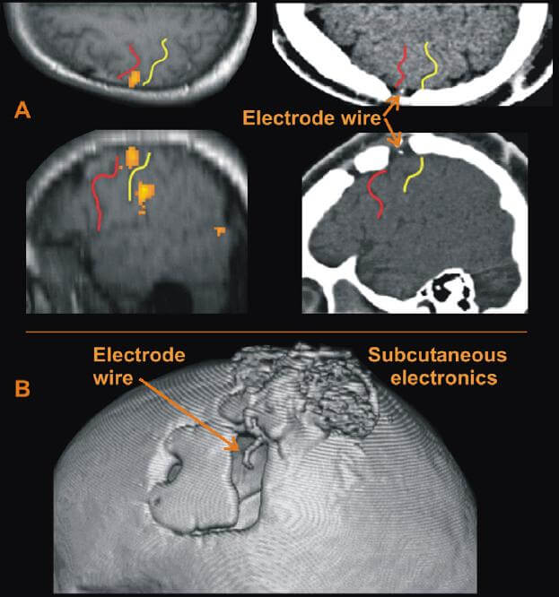 Wireless Device Reads Brain Signals, Turns them into Speech (Video)