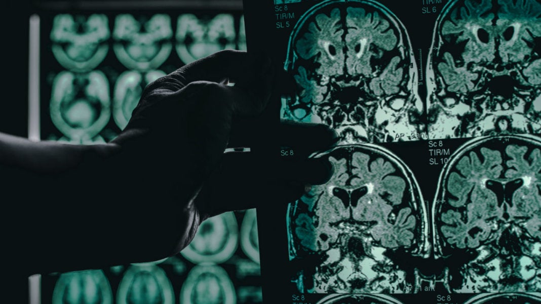 This Memory Prosthesis Boosts Recall in Humans by Roughly 40 Percent