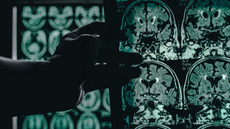 This Memory Prosthesis Boosts Recall in Humans by Roughly 40 Percent